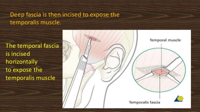 Zygomatic arch fracture