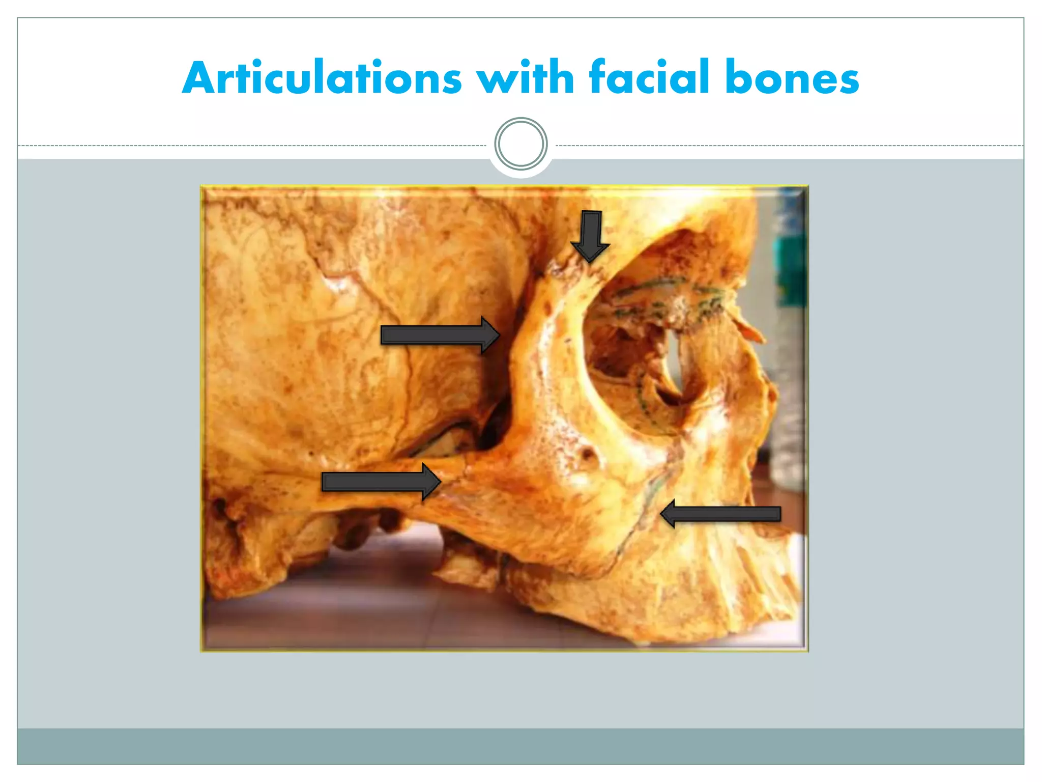 Zygomatic Complex Fracture- ZMC | PPTX