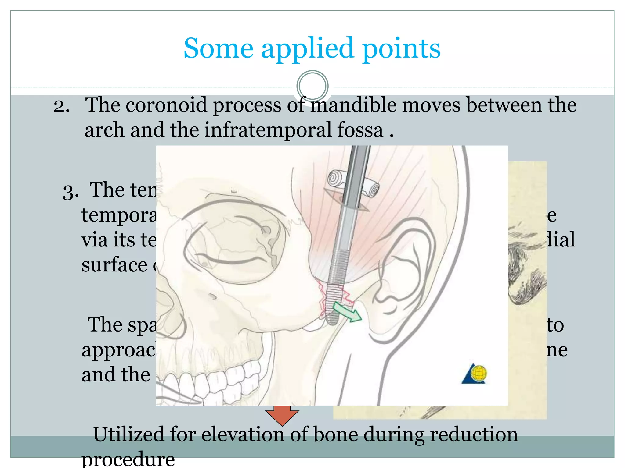Zygomatic Complex Fracture- ZMC | PPTX