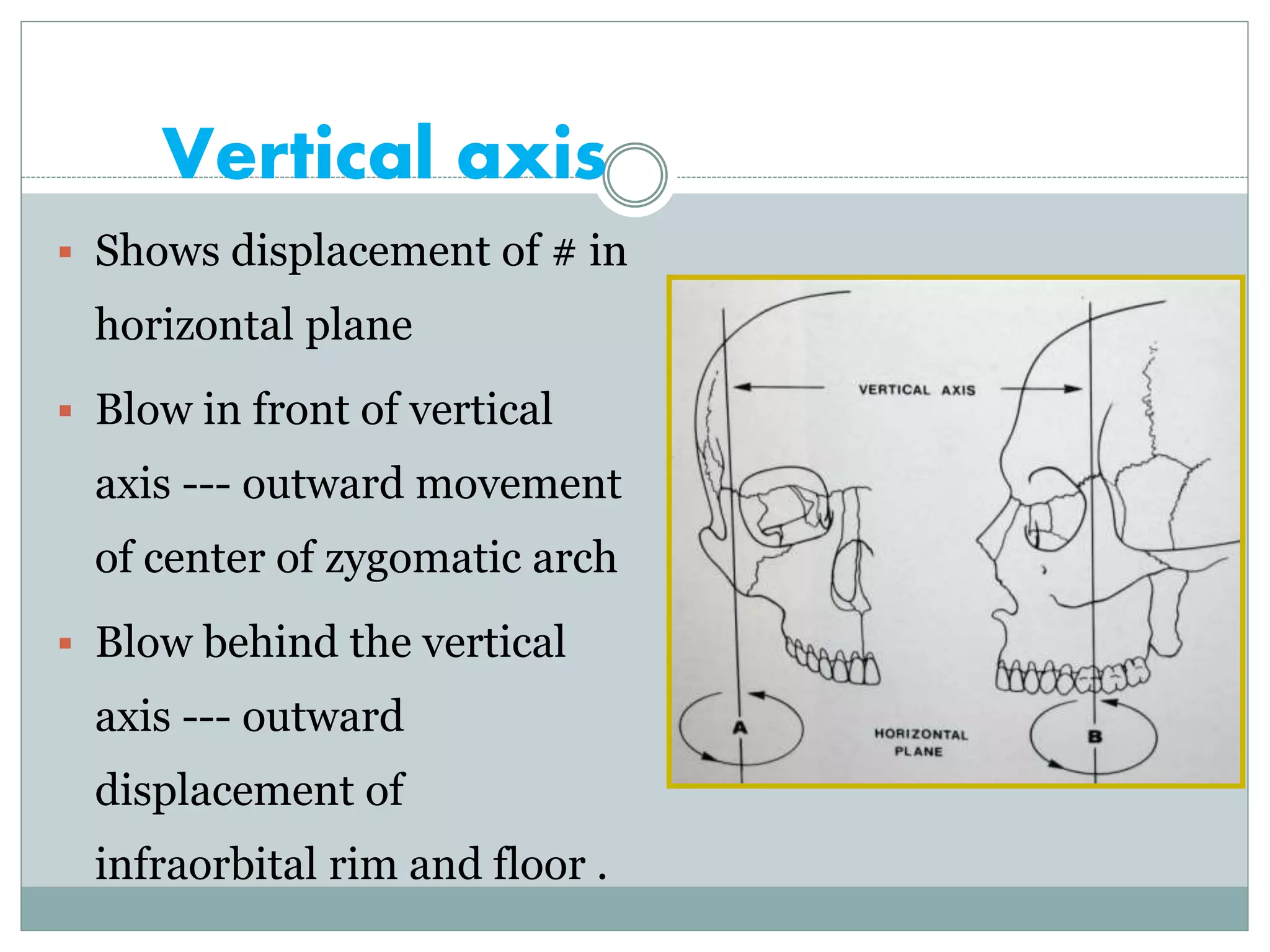 Zygomatic Complex Fracture- ZMC | PPTX