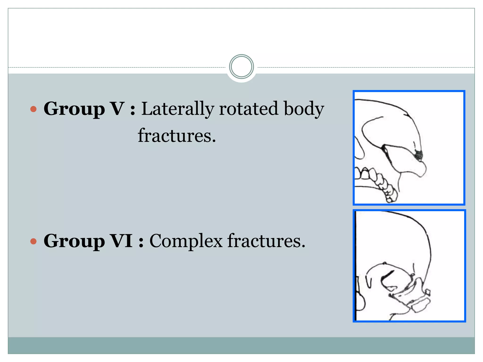 Zygomatic Complex Fracture- ZMC | PPTX