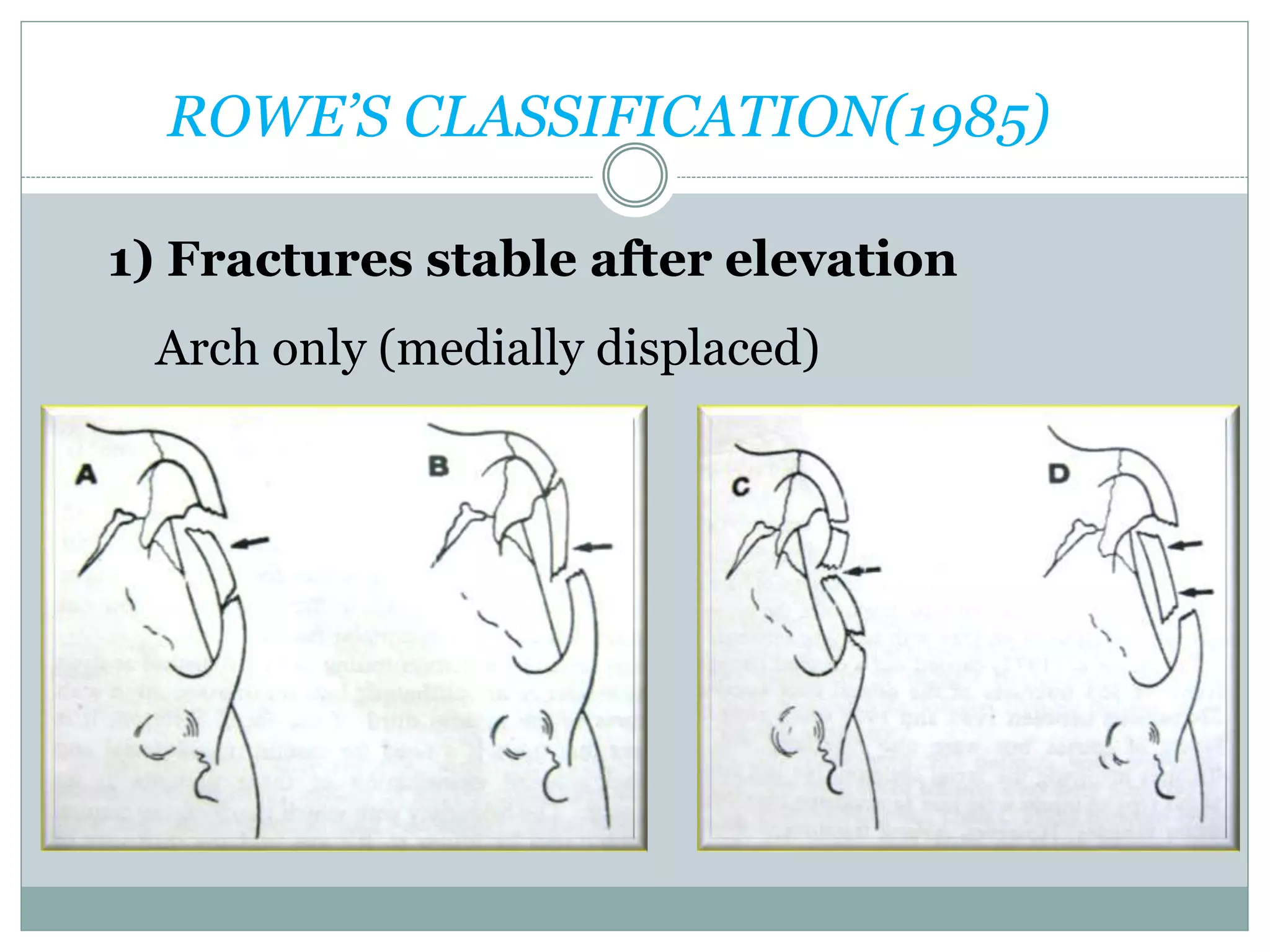 Zygomatic Complex Fracture- ZMC | PPTX