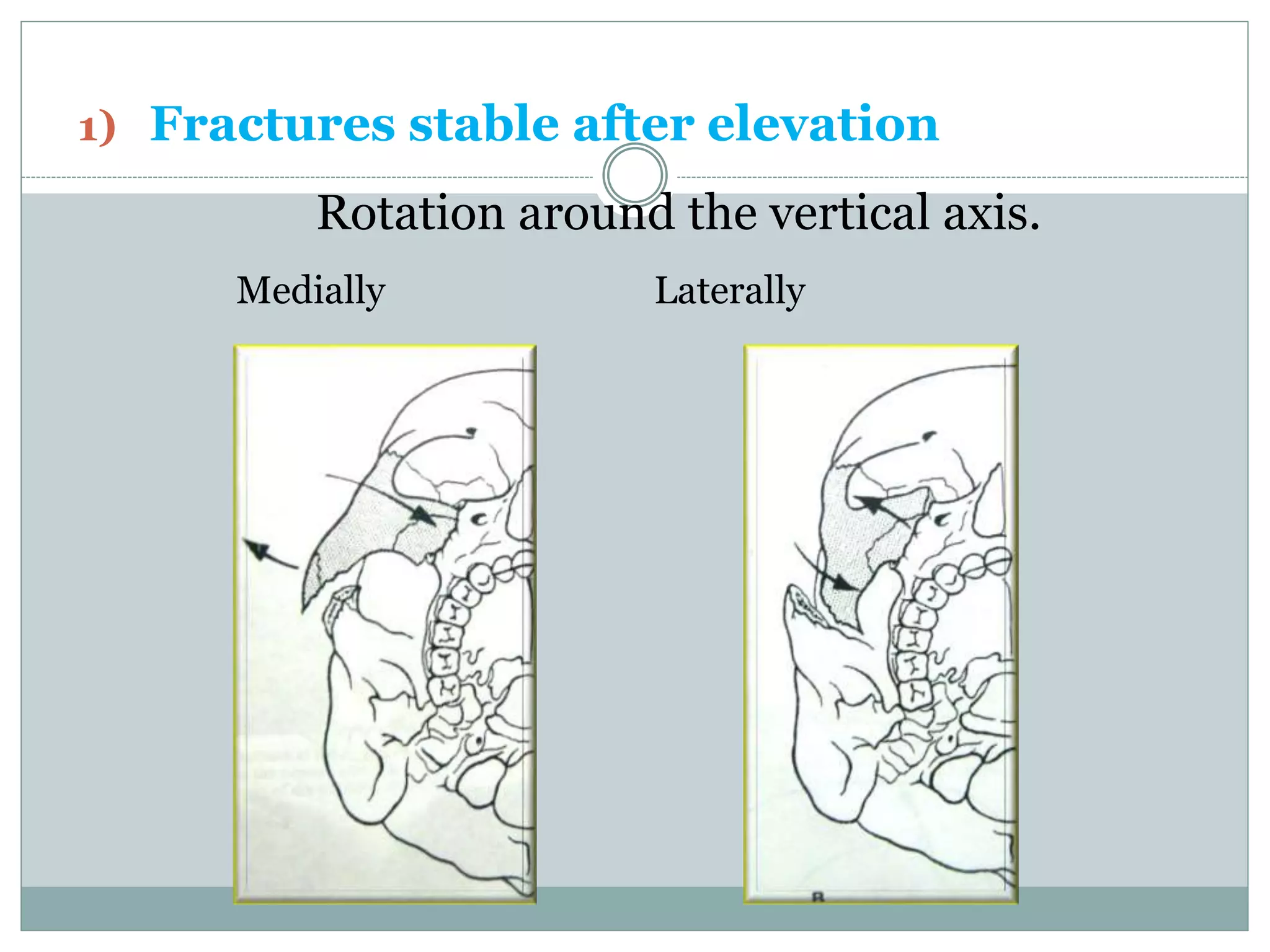 Zygomatic Complex Fracture- ZMC | PPTX