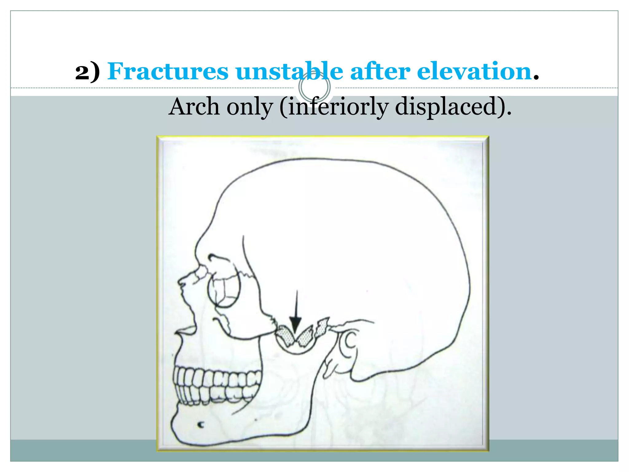 Zygomatic Complex Fracture- ZMC | PPTX