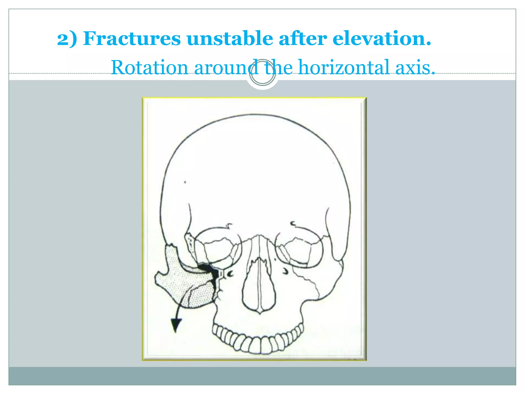 Zygomatic Complex Fracture- ZMC | PPTX