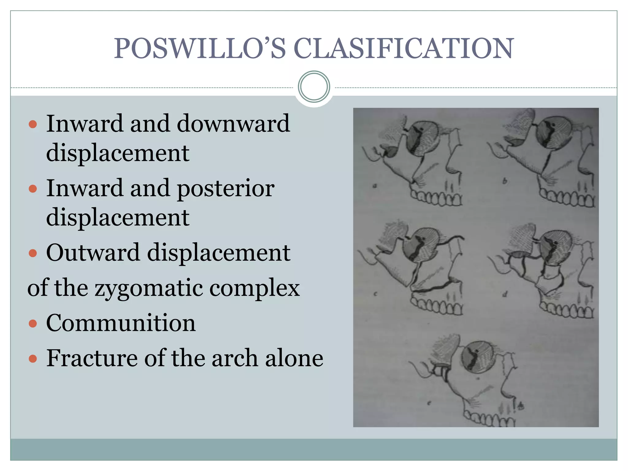Zygomatic Complex Fracture- ZMC | PPTX