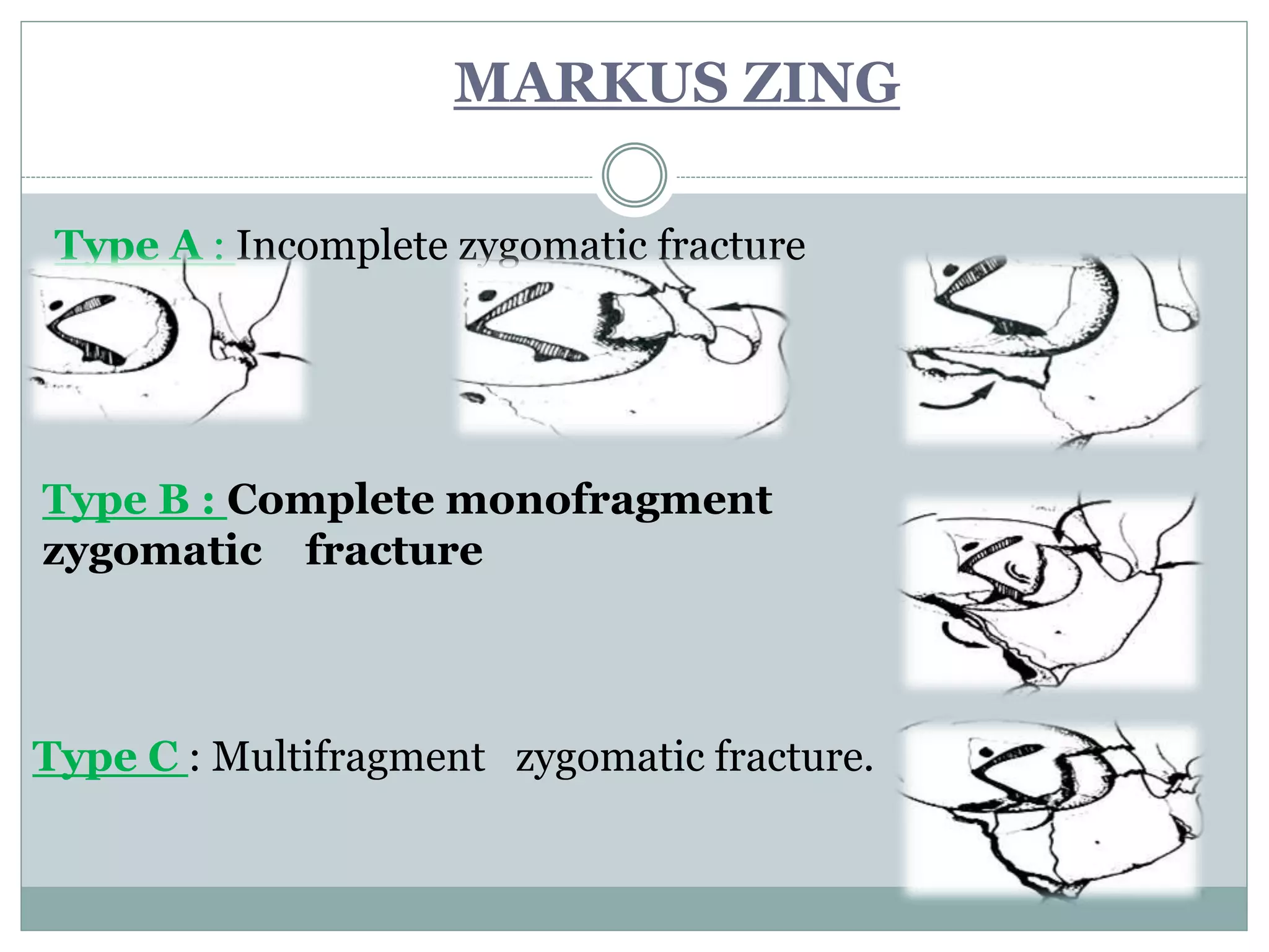 Zygomatic Complex Fracture- ZMC | PPTX