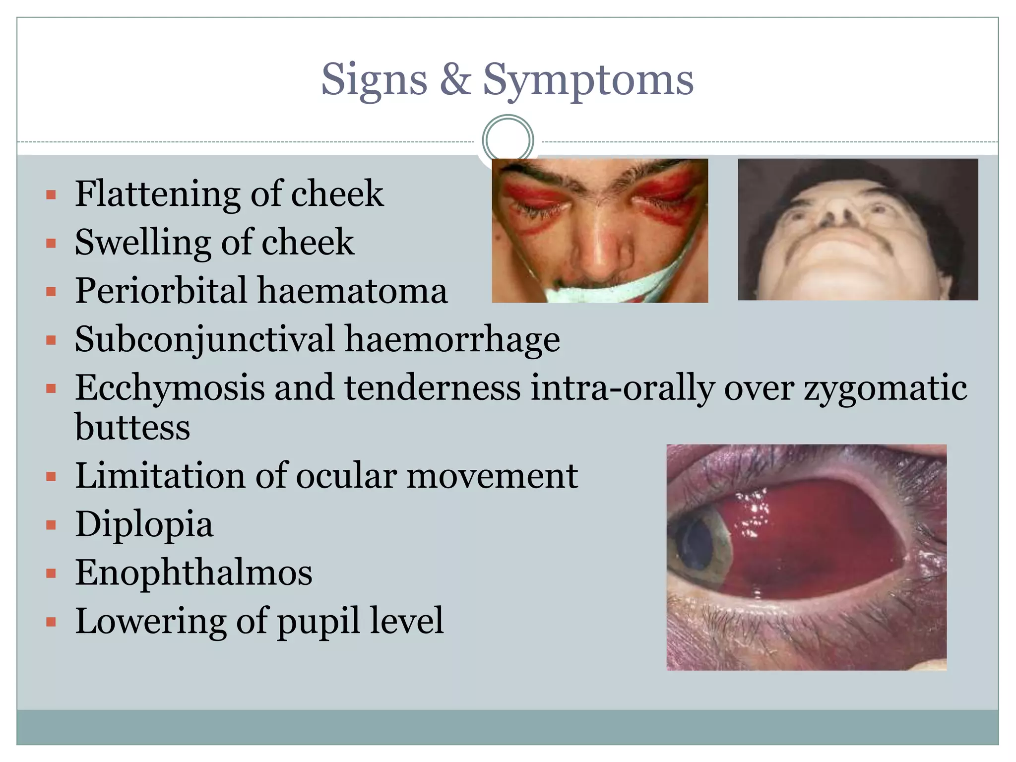 Zygomatic Complex Fracture- ZMC | PPTX