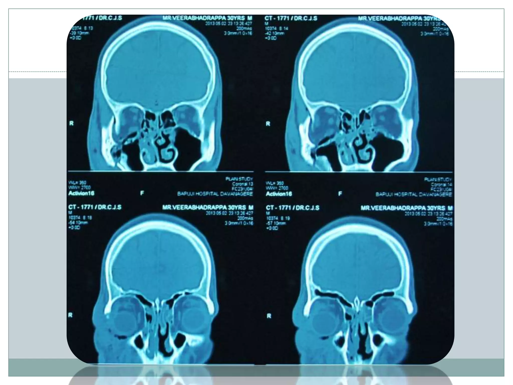 Zygomatic Complex Fracture- ZMC | PPTX