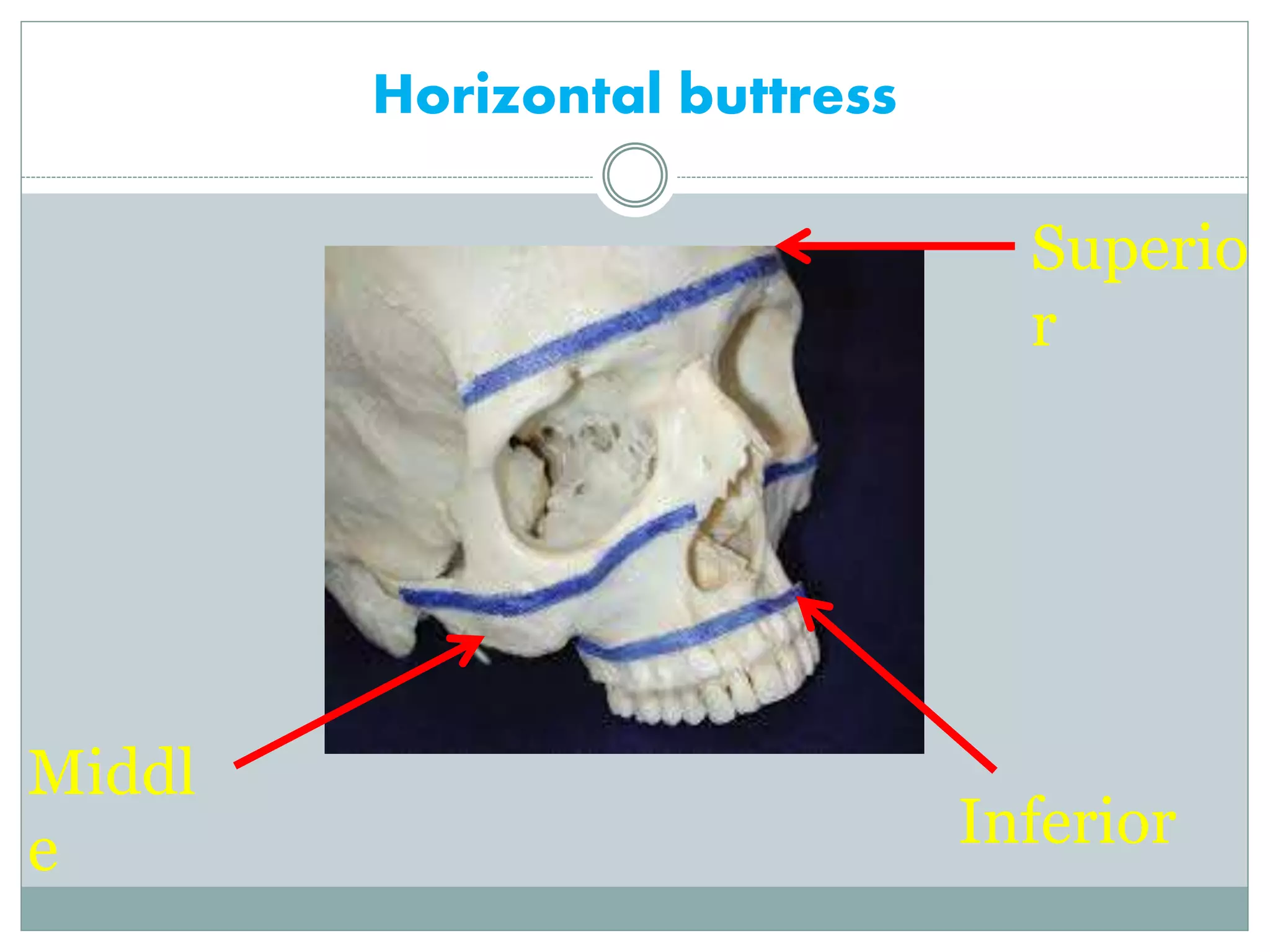 Zygomatic Complex Fracture- ZMC | PPTX