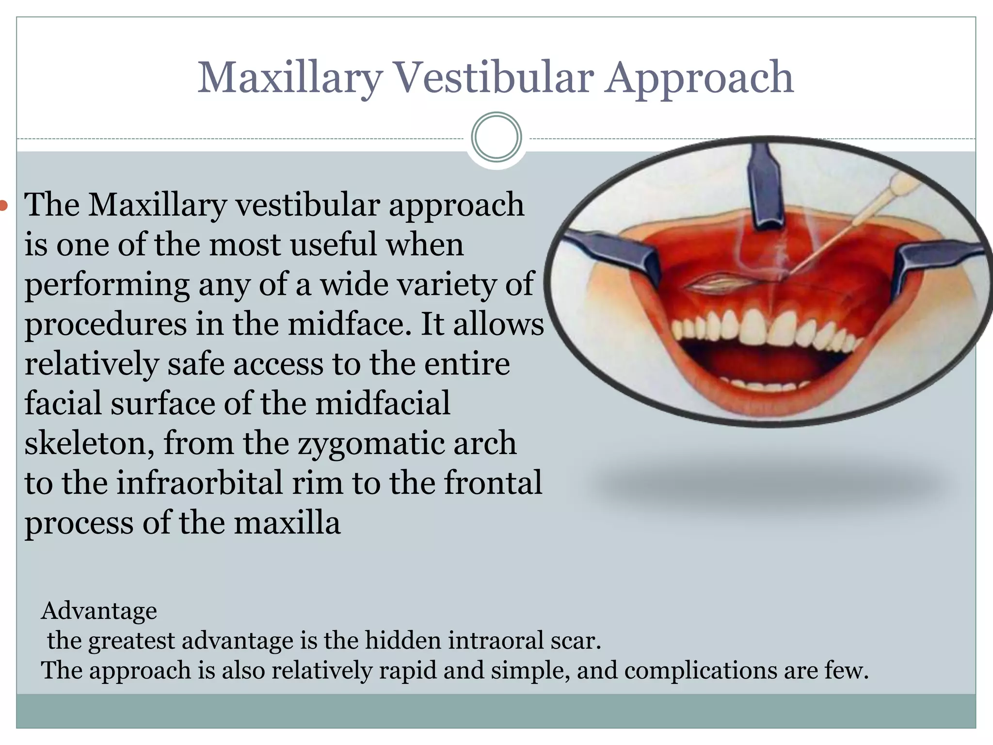 Zygomatic Complex Fracture- ZMC | PPTX