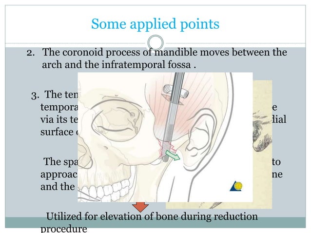 Zygomatic Complex Fracture- ZMC | PPTX | Death, Injury, or Military ...