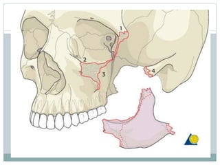 Zygomatic Complex Fracture- ZMC | PPTX