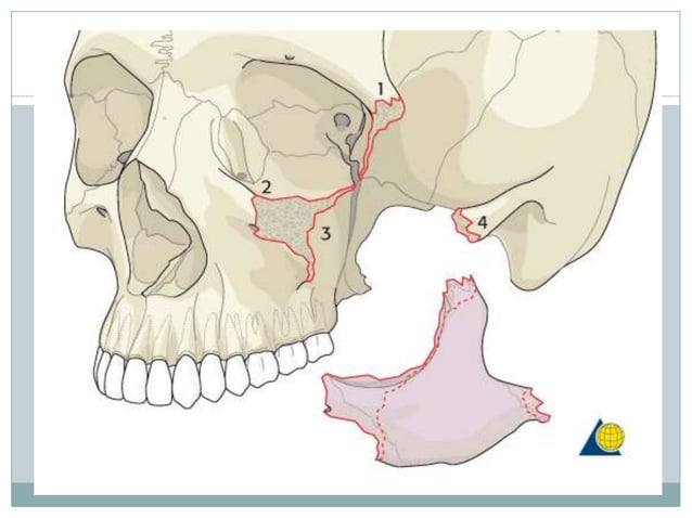 Zygomatic Complex Fracture- ZMC | PPTX | Death, Injury, or Military ...