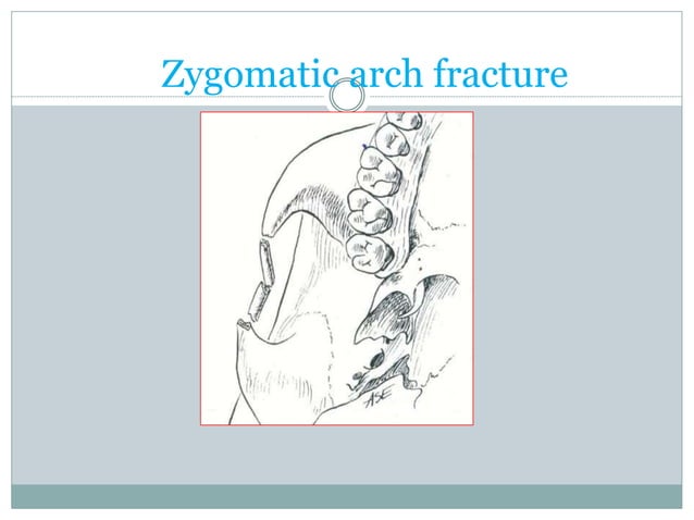 Zygomatic Complex Fracture- ZMC | PPTX | Death, Injury, or Military ...