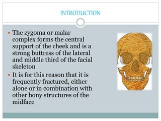 Zygomatic Complex Fracture- ZMC | PPTX