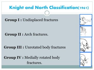 Zygomatic Complex Fracture- ZMC | PPTX