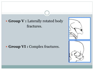 Zygomatic Complex Fracture- ZMC | PPTX