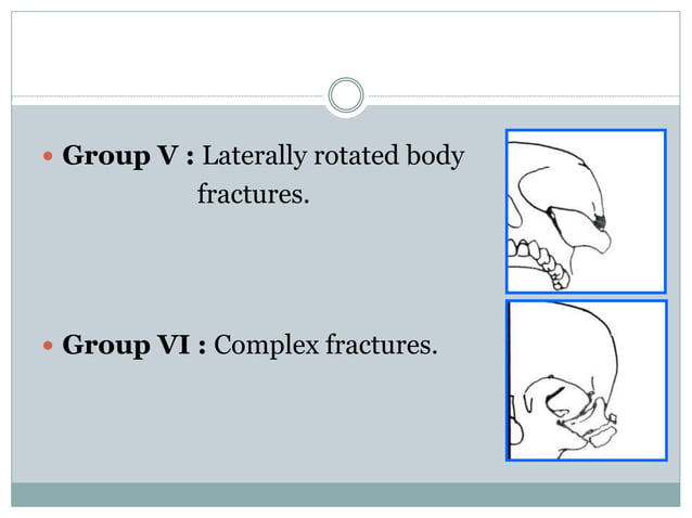 Zygomatic Complex Fracture- ZMC | PPTX | Death, Injury, or Military ...