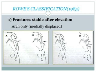 Zygomatic Complex Fracture- ZMC | PPTX