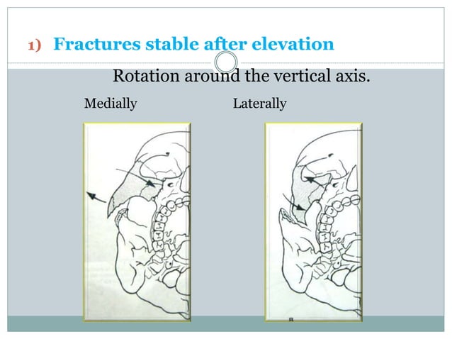 Zygomatic Complex Fracture- ZMC | PPTX | Death, Injury, or Military ...