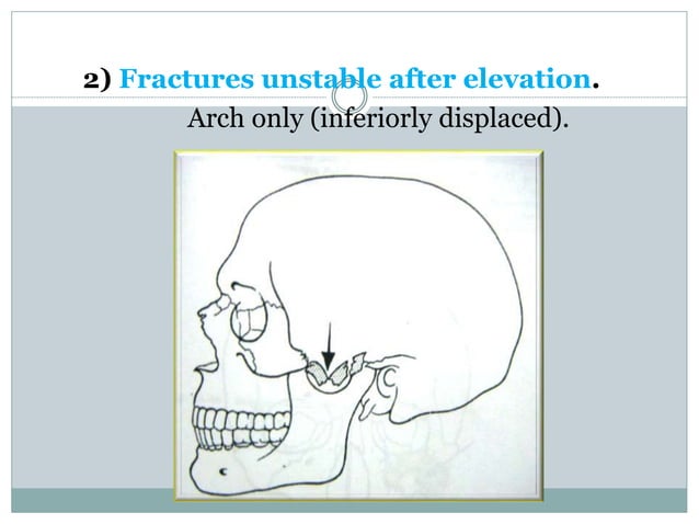 Zygomatic Complex Fracture- ZMC | PPTX | Death, Injury, or Military ...