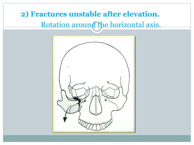 Zygomatic Complex Fracture- ZMC | PPTX | Death, Injury, or Military ...