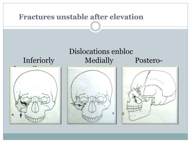 Zygomatic Complex Fracture- ZMC | PPTX | Death, Injury, or Military ...