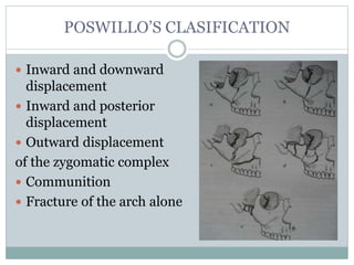 Zygomatic Complex Fracture- ZMC | PPTX