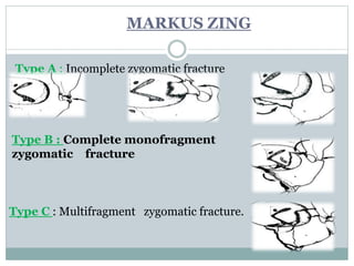 Zygomatic Complex Fracture- ZMC | PPTX