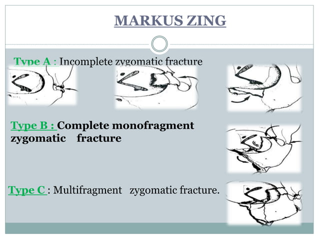 Zygomatic Complex Fracture- ZMC | PPTX | Death, Injury, or Military ...