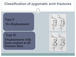 Zygomatic Complex Fracture- ZMC | PPTX