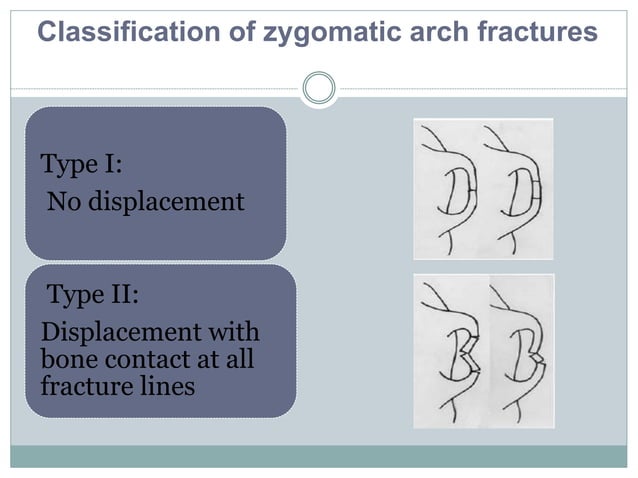 Zygomatic Complex Fracture- ZMC | PPT