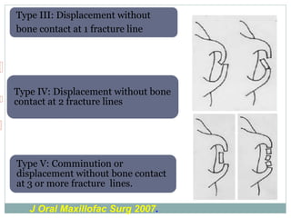 Zygomatic Complex Fracture- ZMC | PPTX