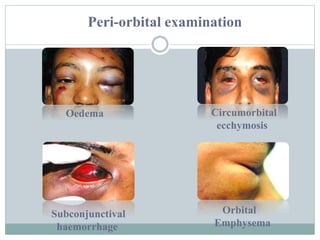 Zygomatic Complex Fracture- ZMC | PPTX