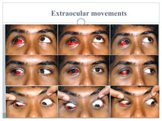 Zygomatic Complex Fracture- ZMC | PPTX
