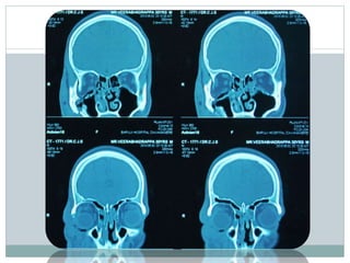 Zygomatic Complex Fracture- ZMC | PPTX