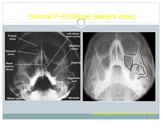 Zygomatic Complex Fracture- ZMC | PPTX