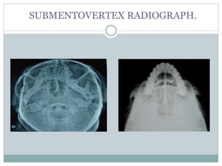 Zygomatic Complex Fracture- ZMC | PPTX