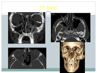 Zygomatic Complex Fracture- ZMC | PPTX