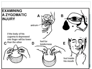 Zygomatic Complex Fracture- ZMC | PPTX