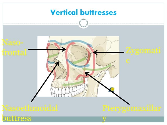 Zygomatic Complex Fracture- ZMC | PPTX | Death, Injury, or Military ...