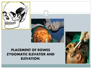 Zygomatic Complex Fracture- ZMC | PPTX