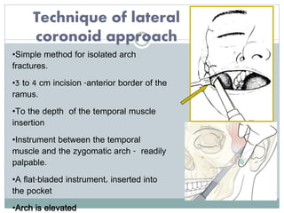 Zygomatic Complex Fracture- ZMC | PPTX