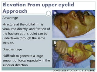Zygomatic Complex Fracture- ZMC | PPTX