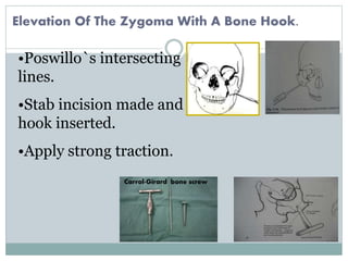 Zygomatic Complex Fracture- ZMC | PPTX