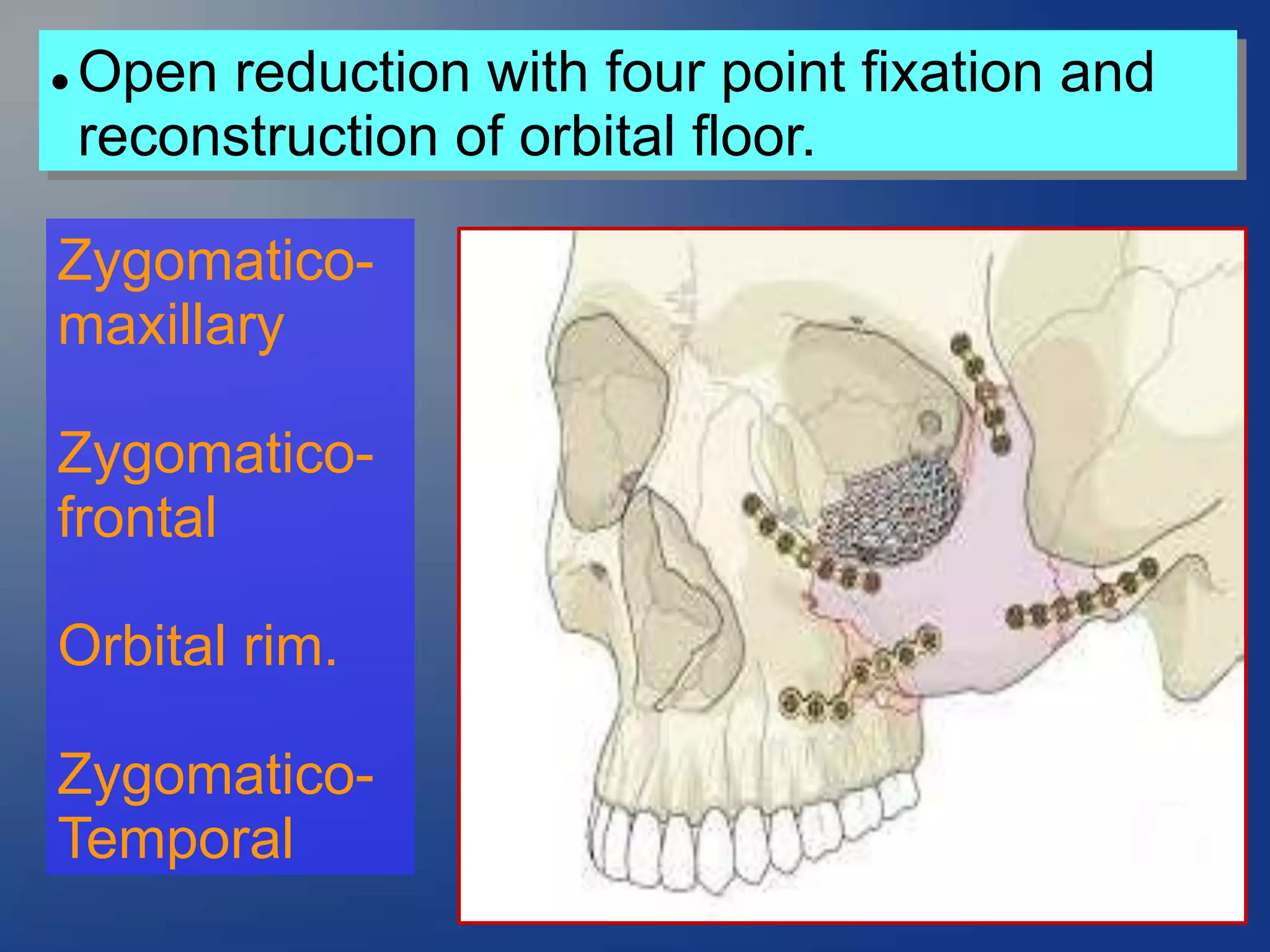 Zygomatic complex fracture | PPT