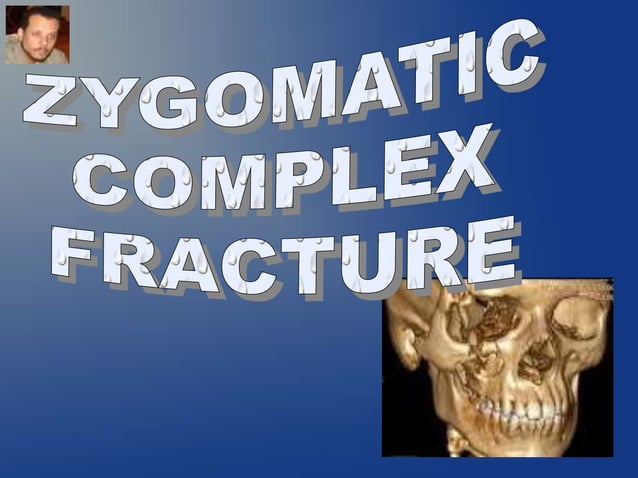 Zygomatic complex fracture | PPT