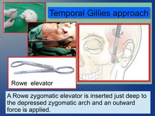 Zygomatic complex fracture | PPT