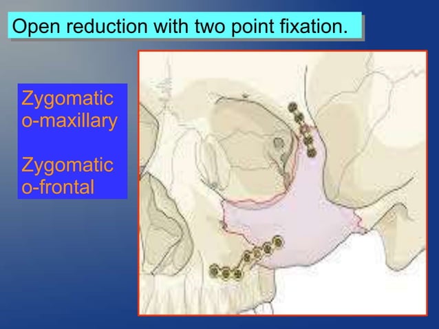 Zygomatic complex fracture | PPT